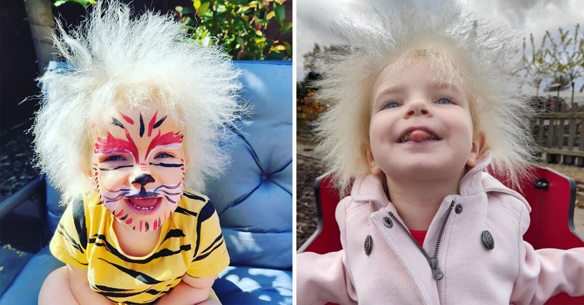 How is life for a little British woman who has untangleable hair syndrome?